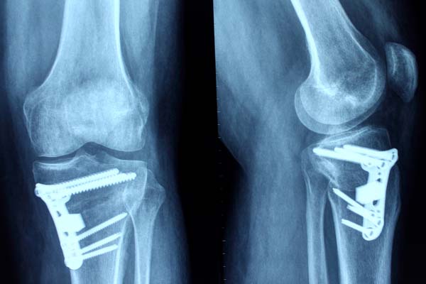 Tratamentul chirurgical in gonartroza: Ce optiuni ai daca vrei sa te ...